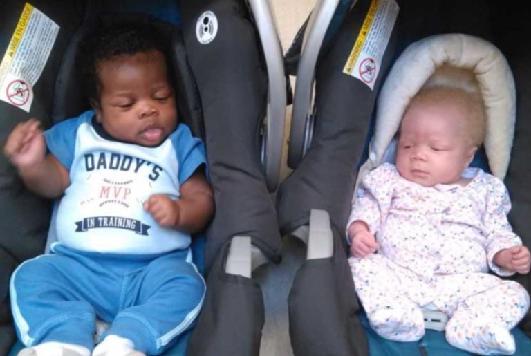 These unique twins with different skin tones have grown up and here is ...