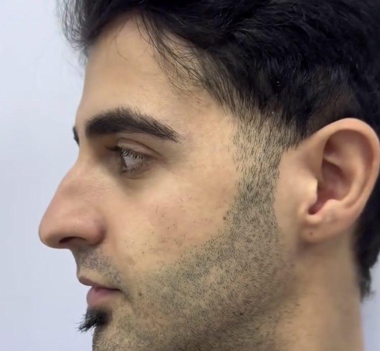 One Nose Job Completely Changed His Face and The Difference Is Shocking ...
